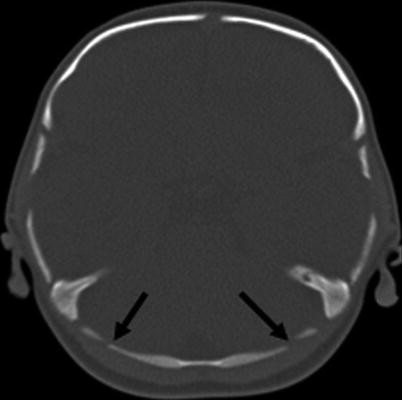 Pediatric Skull: Normal Pediatric Sutures on Computed Tomography ...