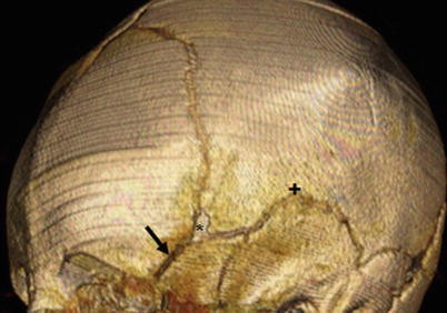 Pediatric Skull: Normal Pediatric Sutures on Computed Tomography ...
