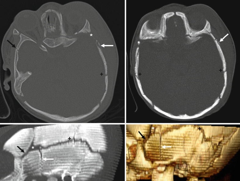 Pediatric Skull: Normal Pediatric Sutures on Computed Tomography ...