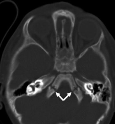 Pediatric Skull: Normal Pediatric Sutures on Computed Tomography ...