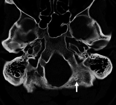 Pediatric Skull: Normal Pediatric Sutures on Computed Tomography ...