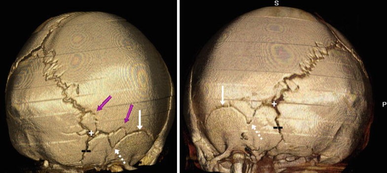 Normal Variations and Developmental Anatomy of the Calvarial Sutures ...