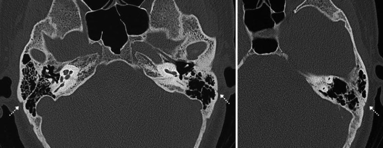 Normal Variations and Developmental Anatomy of the Calvarial Sutures ...