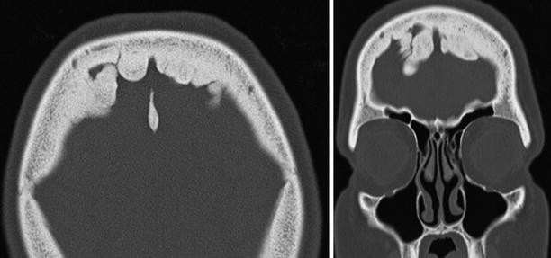 Normal Variations in Calvarial Contour, Irregular Ossification/Aeration ...