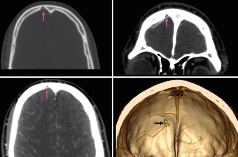 Other “Don’t Touch” Skull Lesions: Arachnoid Granulations, Calvarial ...