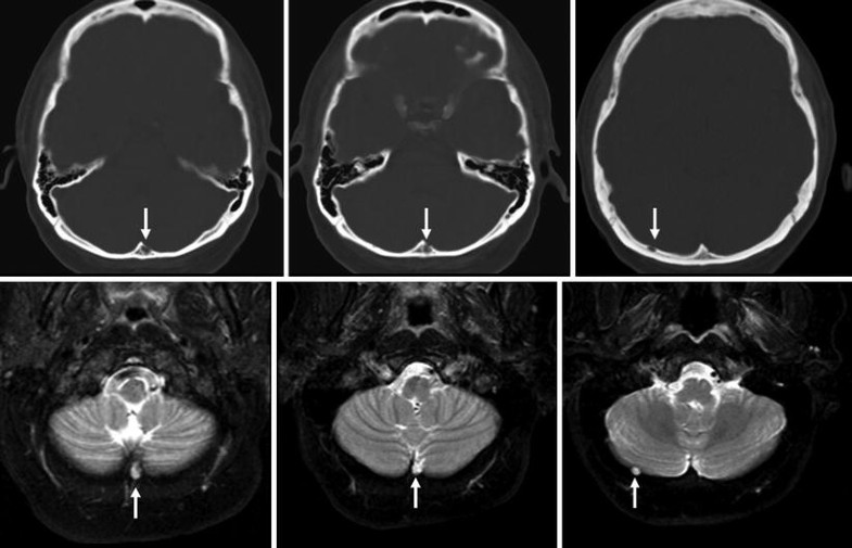 Other “Don’t Touch” Skull Lesions: Arachnoid Granulations, Calvarial ...