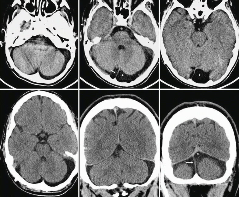Mega Cisterna Magna and Retrocerebellar Arachnoid Cysts | SpringerLink
