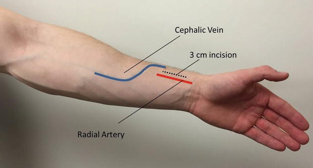 Direct Anastomosis: Cephalic Vein Hemodialysis Access | SpringerLink