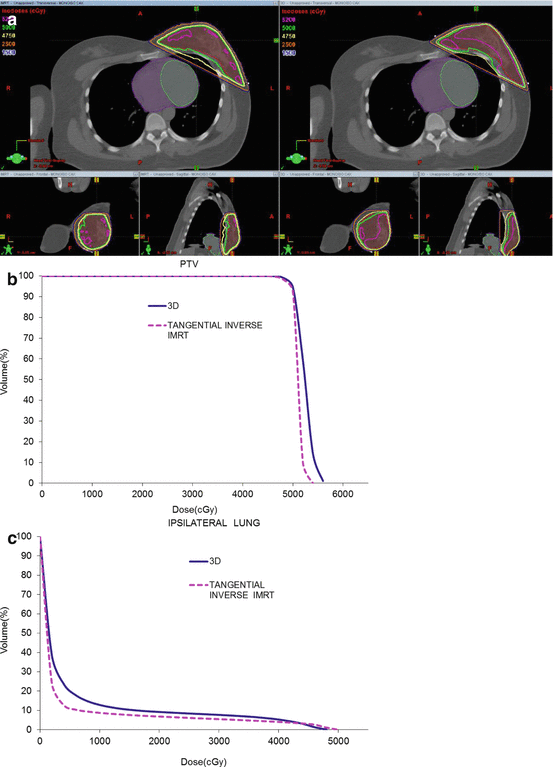 Intensity-Modulated Radiation Therapy for Breast Cancer | SpringerLink