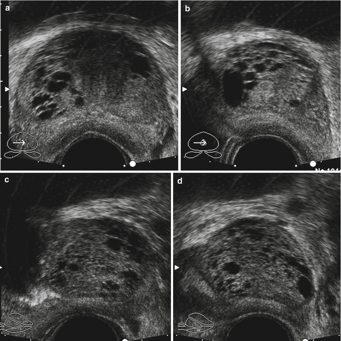 Prostatic Cysts | SpringerLink