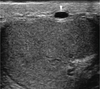 The Testicles: Cystic Lesions | SpringerLink