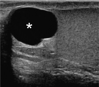 The Testicles: Cystic Lesions | SpringerLink