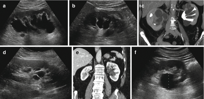 Cystic Diseases of the Kidney | SpringerLink