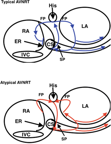 AV Nodal Re-entry Tachycardia (AVNRT) | SpringerLink