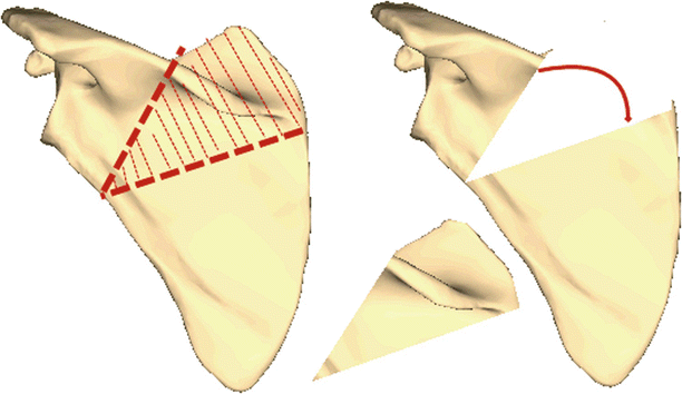 Evidence-Based Treatment of Sprengel Deformity | SpringerLink