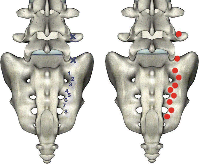 Radiofrequency Ablation for Sacroiliac Joint Pain | SpringerLink