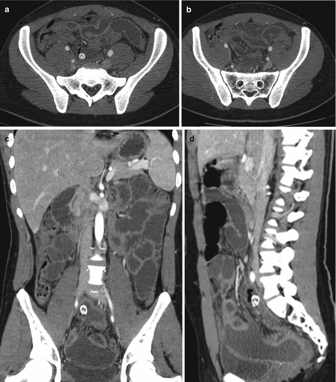 Acute Appendicitis | SpringerLink