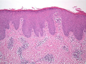 Spongiotic Dermatitis | SpringerLink