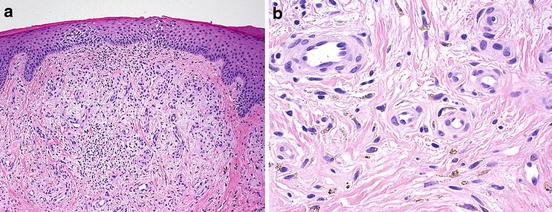 Spongiotic Dermatitis | SpringerLink