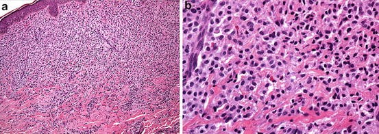 Perivascular Dermatitis | SpringerLink