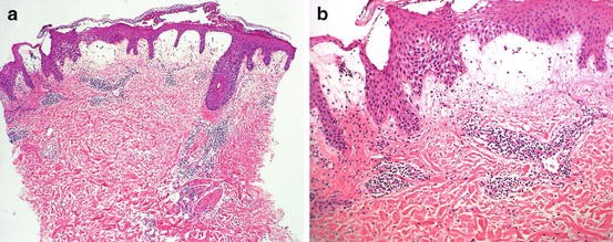 Perivascular Dermatitis | SpringerLink