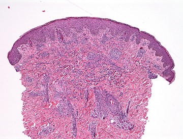 Perivascular Dermatitis | SpringerLink