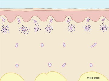 Perivascular Dermatitis | SpringerLink