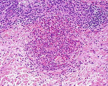 Perivascular Dermatitis | SpringerLink