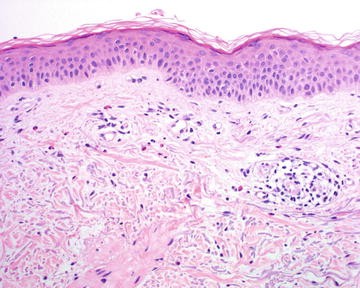 Perivascular Dermatitis | SpringerLink