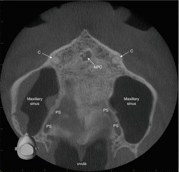 Hard and Soft Palate | SpringerLink