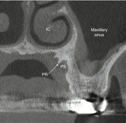 Hard and Soft Palate | SpringerLink