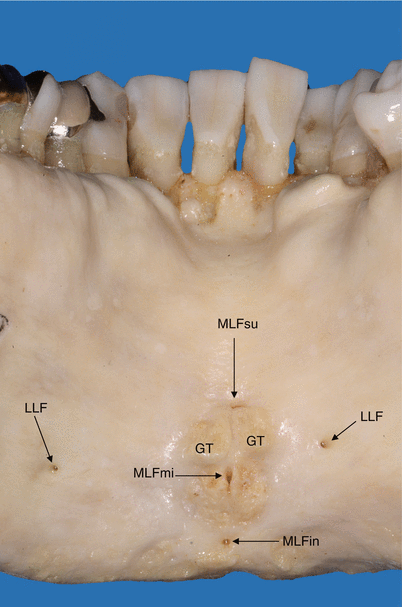 Lingual Foramina and Canals | SpringerLink