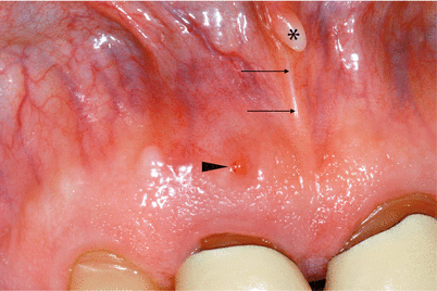 Vestibule and Cheeks | SpringerLink