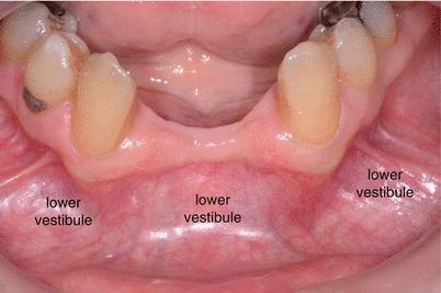 Vestibule and Cheeks | SpringerLink