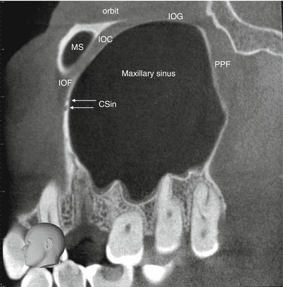 Infraorbital Region | SpringerLink