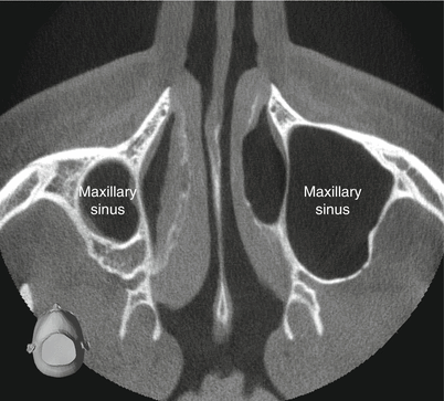 Maxillary Sinus | SpringerLink