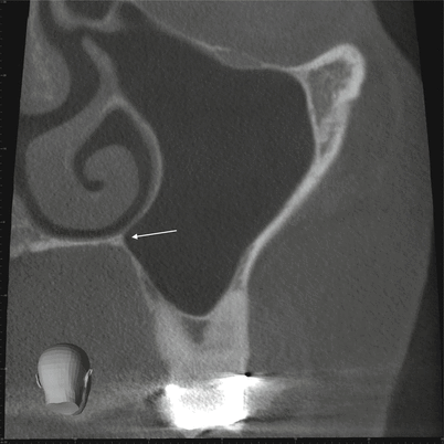 Maxillary Sinus | SpringerLink