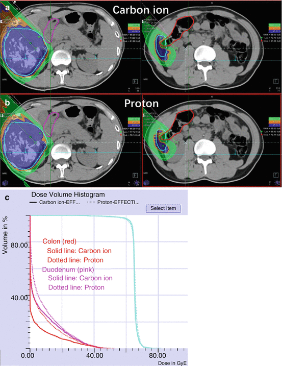 Carbon Ion Radiation Therapy for Liver Tumors | SpringerLink