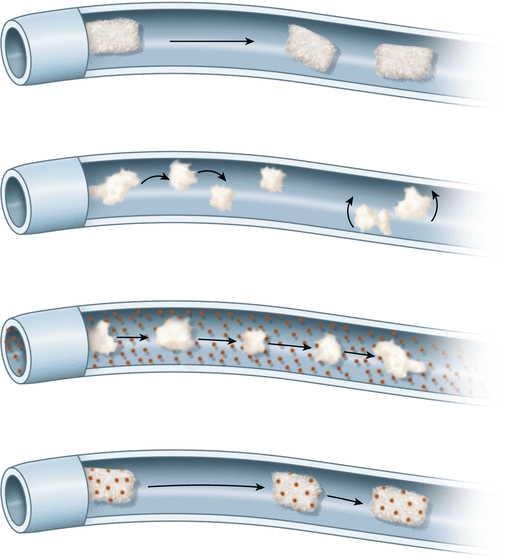 Materials Used for Vascular Embolization | SpringerLink
