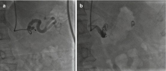 Splenic Artery Embolization for Non-surgical Splenectomy | SpringerLink