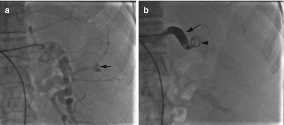 Splenic Artery Embolization for Non-surgical Splenectomy | SpringerLink