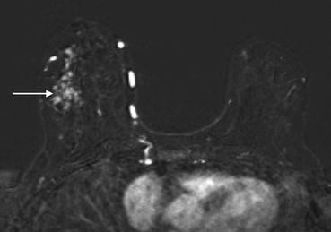 Breast Biopsy and Breast MRI Wire Localization | SpringerLink