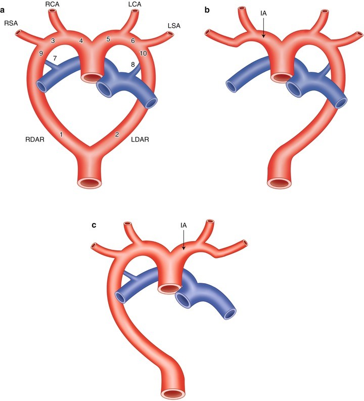Vascular Rings and Anomalies of the Aortic Arch Vessels | SpringerLink