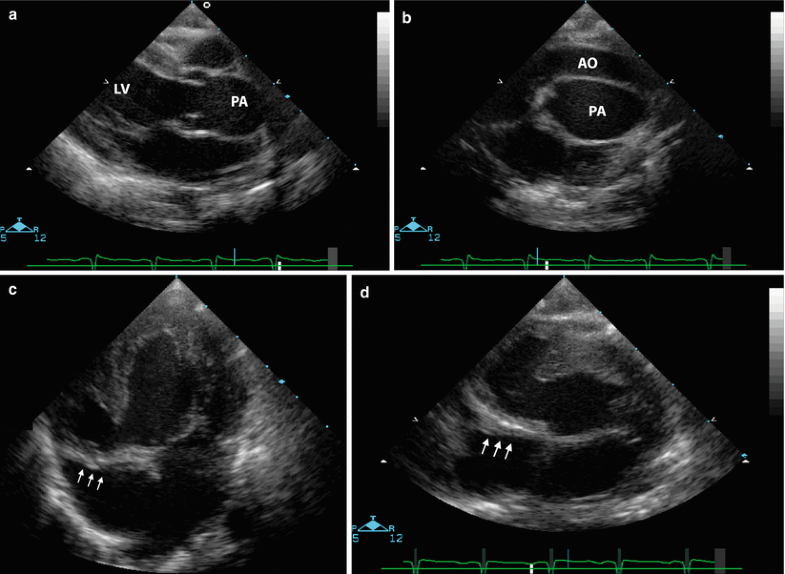 Tricuspid Atresia | SpringerLink