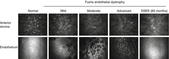 Optical and Anatomic Changes in Fuchs Endothelial Dystrophy Corneas ...
