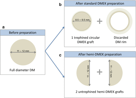 Evolution of Posterior Lamellar Keratoplasty: PK – DLEK – DSEK/DSAEK ...