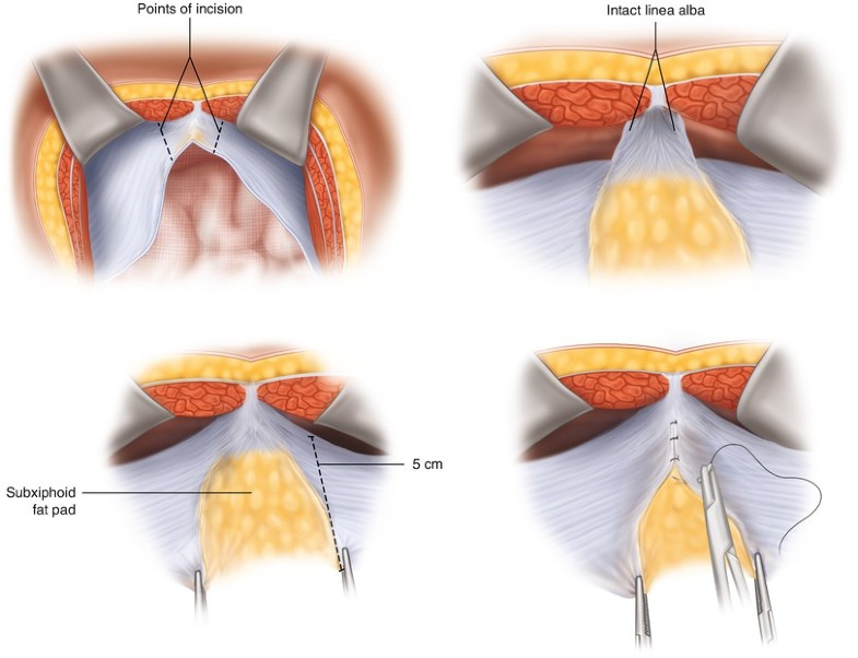 Retrorectus Hernia Repair and Transversus Abdominis Release | SpringerLink