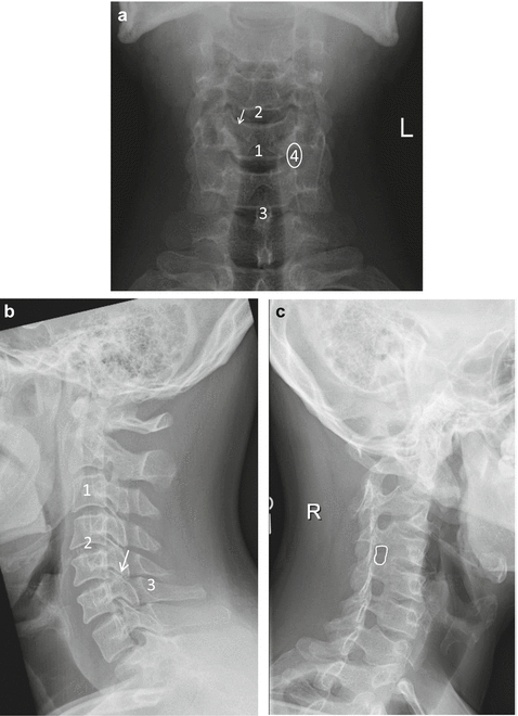 Cervical Spine Imaging: Normal Anatomy and Degenerative Disease ...