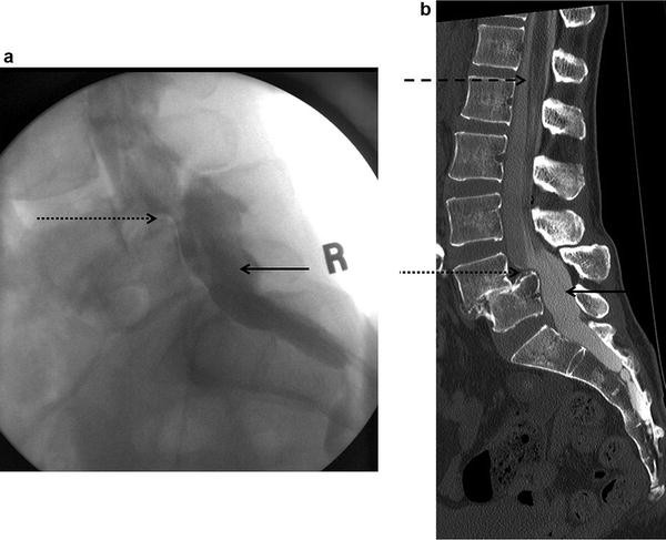 Lumbar Spine Imaging: Myelography | SpringerLink
