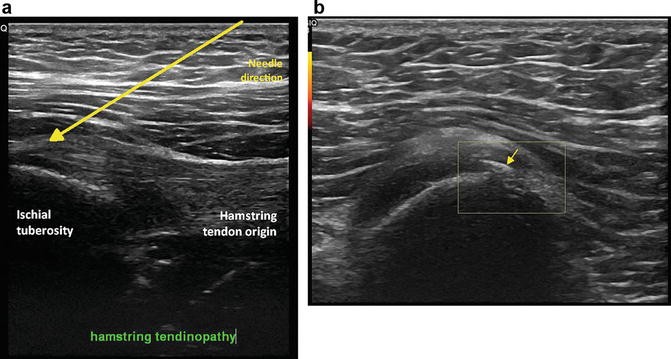 Ischial Bursa Injection | SpringerLink
